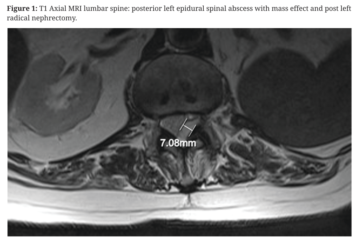Spinal epidural abscesses – The BMAS Blog