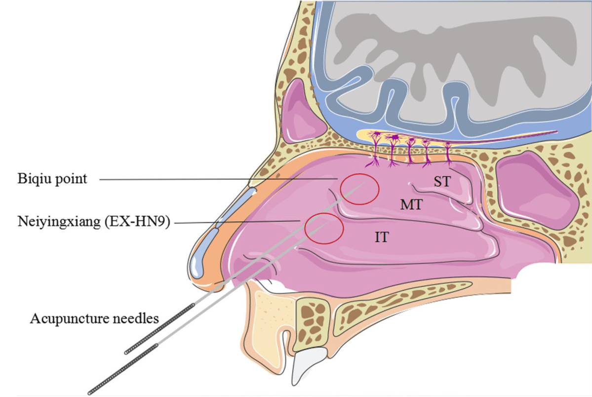 Intranasal acupuncture 2023 – The BMAS Blog