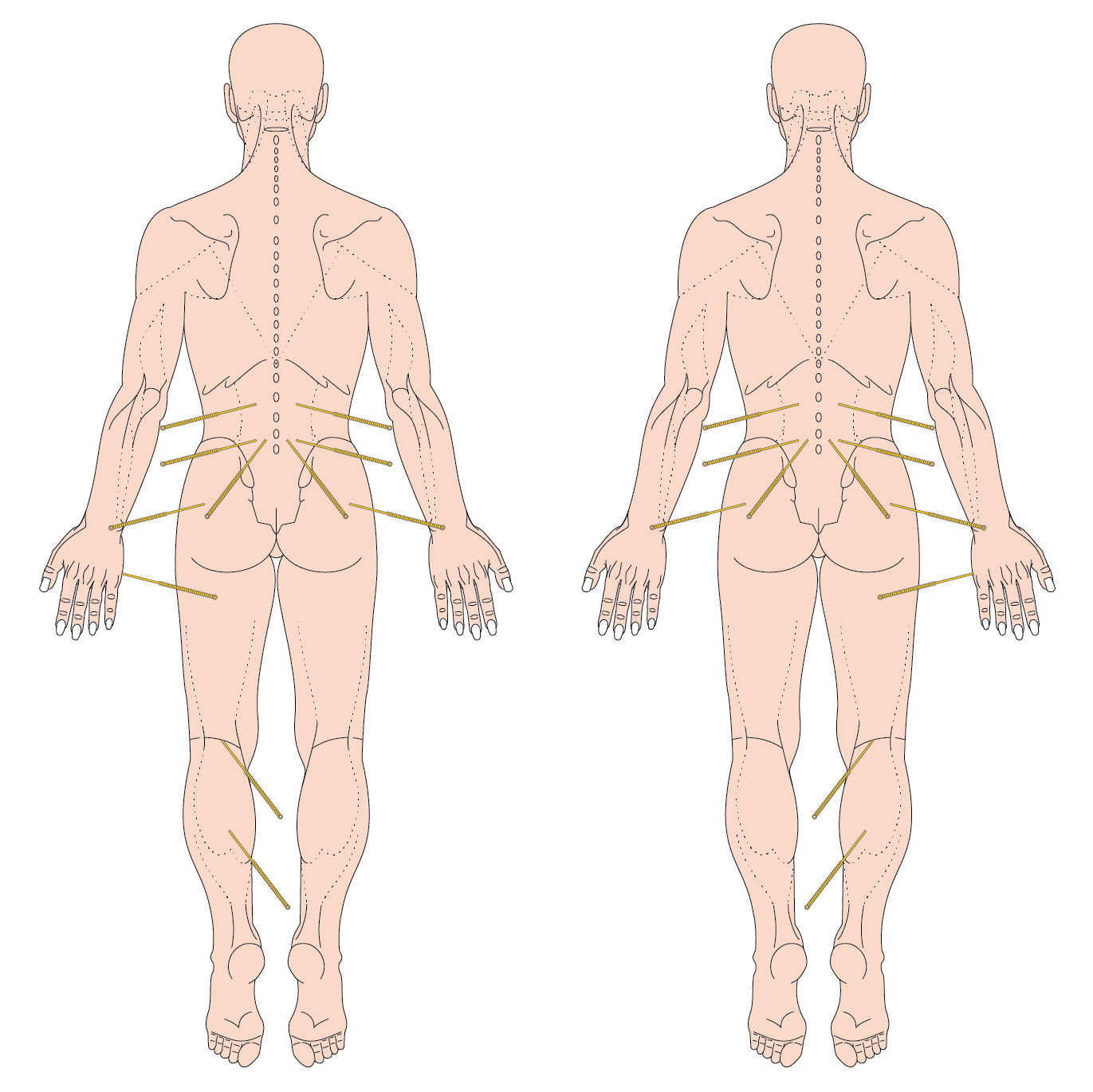 Acupuncture plus manipulation in LDH – The BMAS Blog